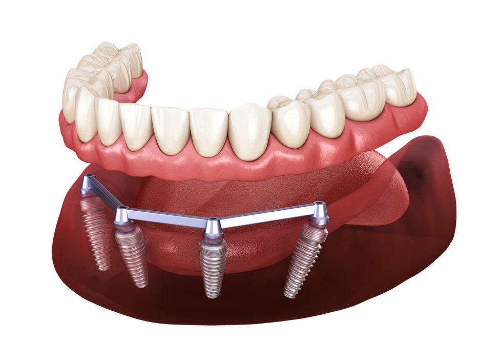 Hybrid & Implant Supported Dentures | Dentist Care | Ashland OR
